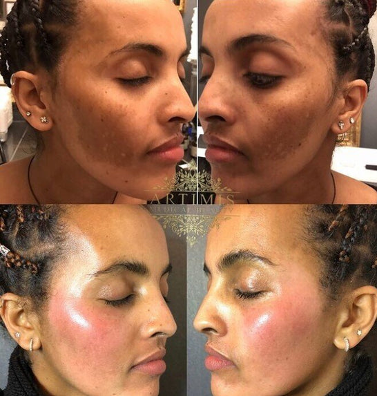 MeLine® Peel Auckland | Treatment for Hyperpigmentation – Precision Skin