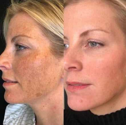 Transform Your Skin's Tone & Texture | Meline Treatment at ...